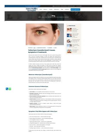 Yellow Eyes (Jaundice Eyes) Causes, Symptoms & Treatments