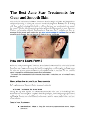 The Best Acne Scar Treatments for Clear and Smooth Skin - theglomedispa589 Flip PDF | AnyFlip
